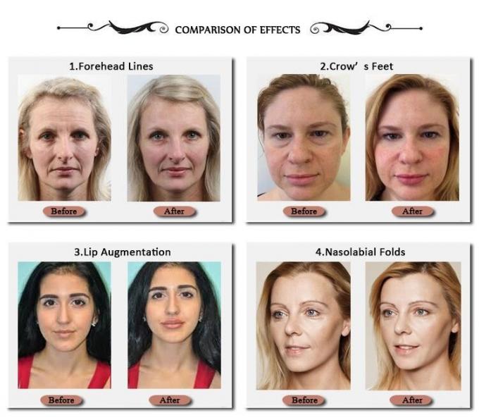 Butt Lift Butt Injections Dermal Filler PLLA 1.5g Wrinkles Removal