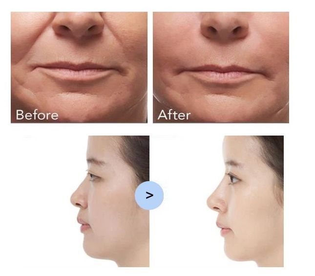 High Press Hyaluron Filler Pen Ha Pen Lip Filler Dermal Filler 0.5kg