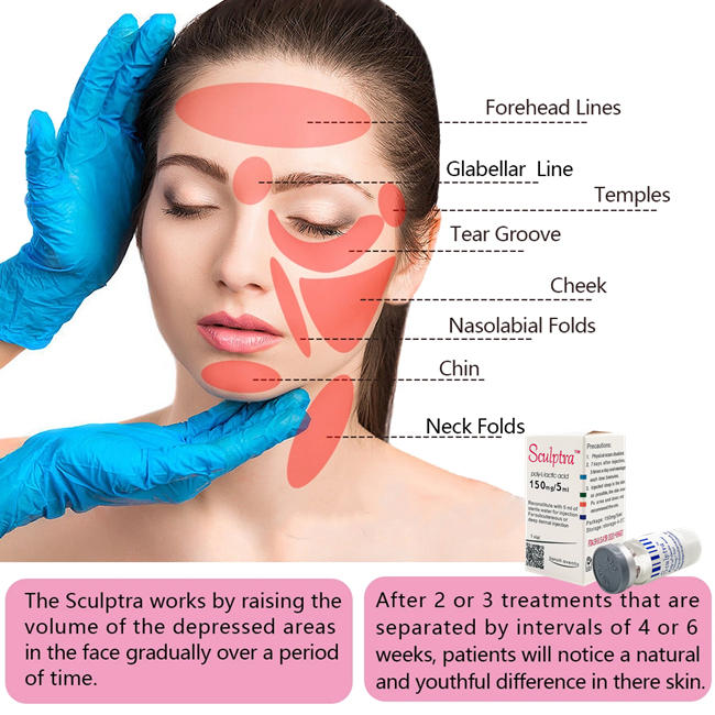 Butt Lift Butt Injections Dermal Filler PLLA 1.5g Wrinkles Removal