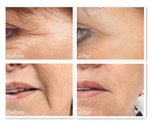 Injection Anti Wrinkles Botulinum Toxin Poison 100 Units BTX Slimmer ...